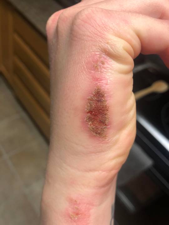 Eraser Challenge Burn